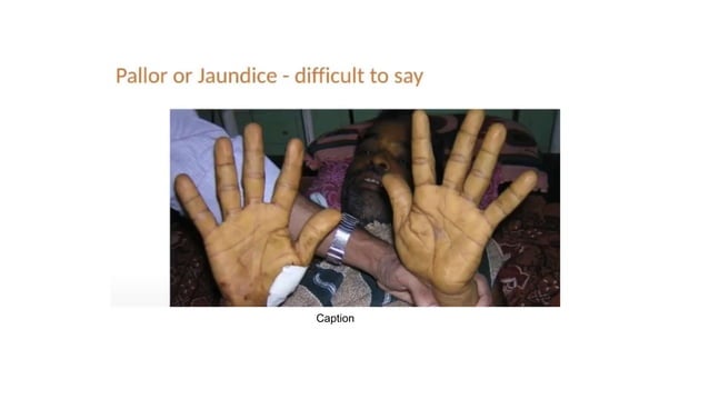 Pallor | PPTX | Blood Disorders | Diseases and Conditions