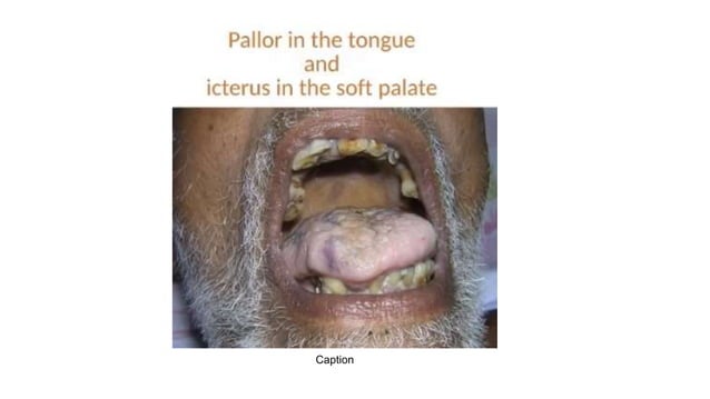 Pallor | PPTX | Blood Disorders | Diseases and Conditions