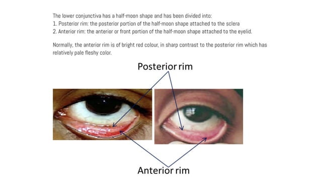 Pallor | PPTX | Blood Disorders | Diseases and Conditions