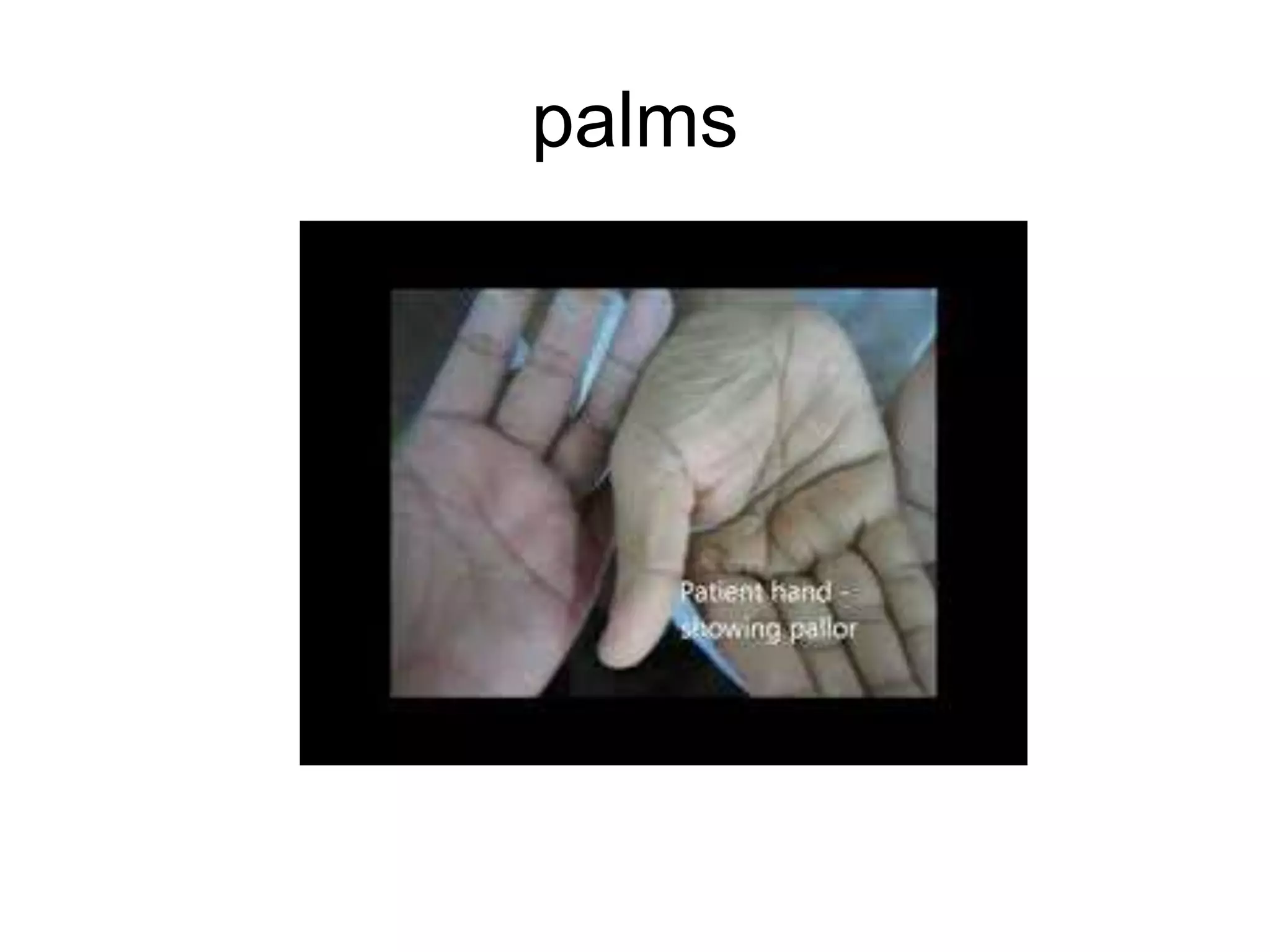 Pallor.pptx