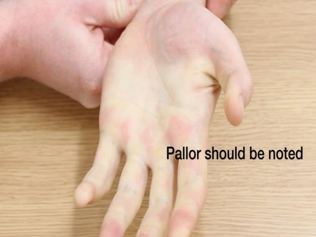 Pallor agp | PPTX | Blood Disorders | Diseases and Conditions