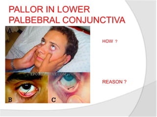 Pallor Conjunctiva
