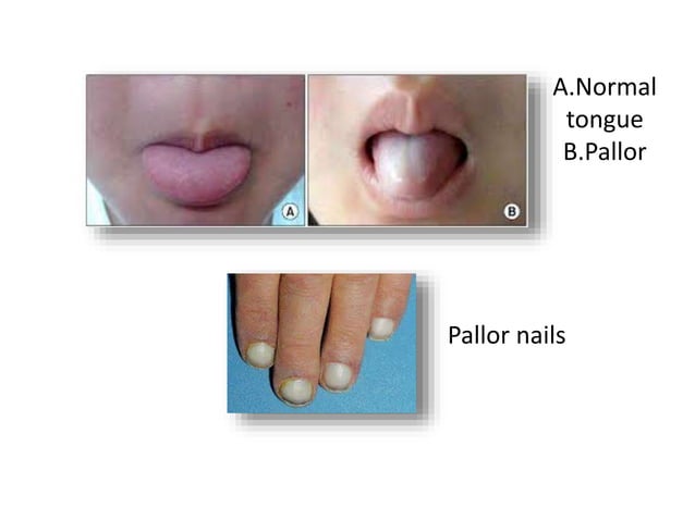 Causes and types of pallor which are clinically signufucant | PPT