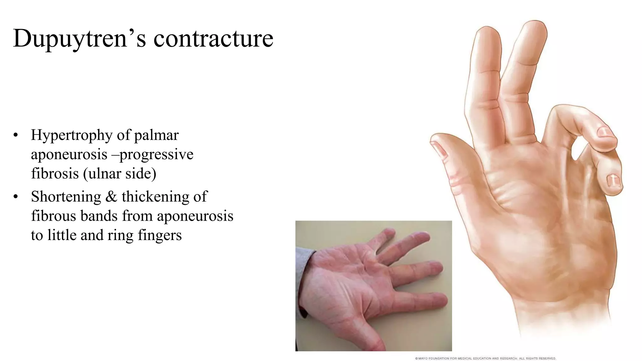 palmar aponeurosis & muscles.pptx