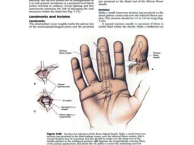 Palmar spaces | PPT | Death, Injury, or Military Conflict | Sensitive ...