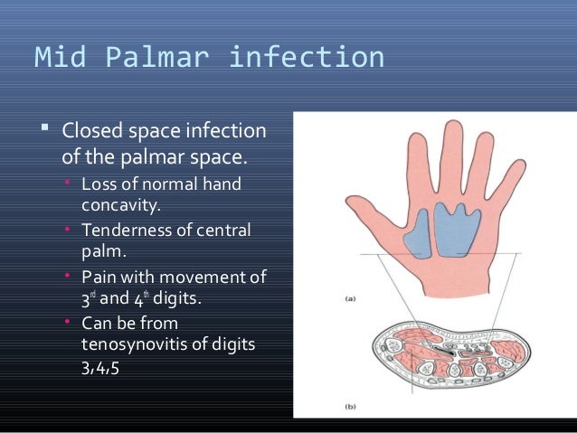 Palmar Spaces Human Anatomy