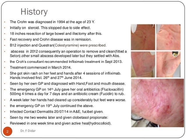 Palmoplantar pustolar psoriasis induced with infliximab in treating