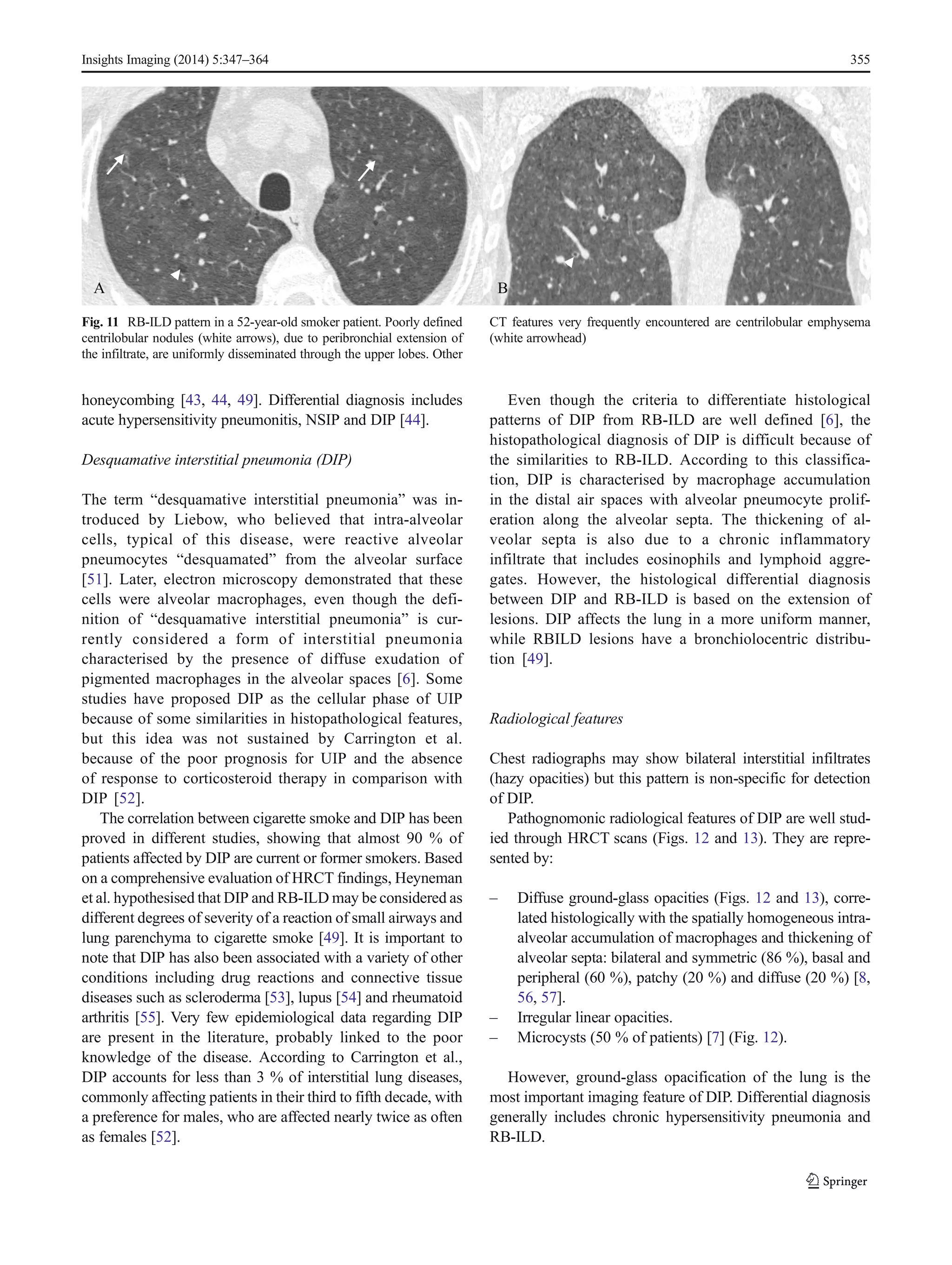 Clinical and radiological features of idiopathic interstitial ... Clinical and radiological features of idiopathic interstitial ...