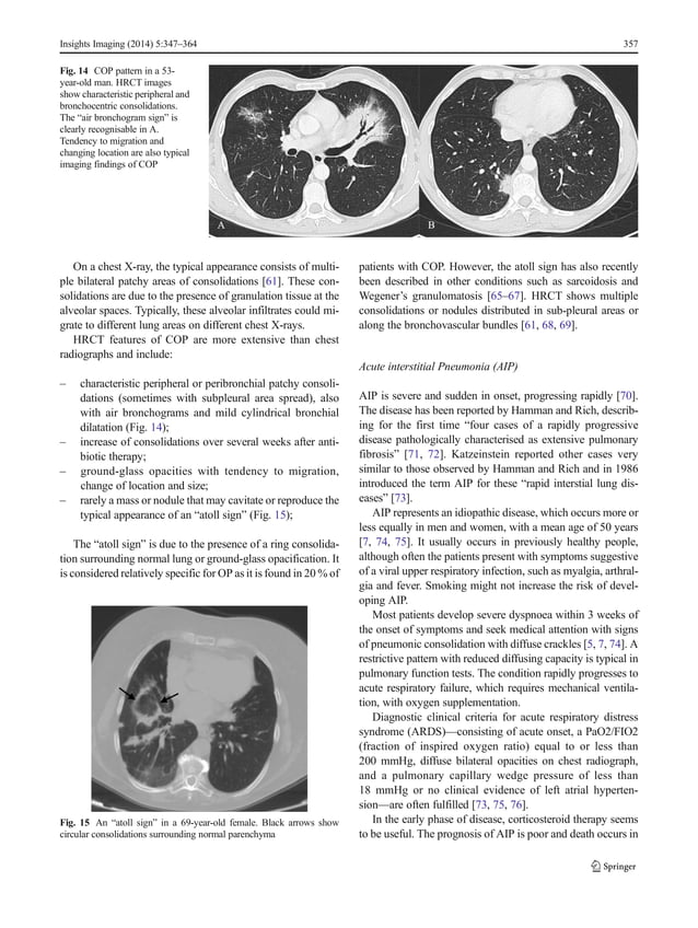 Clinical and radiological features of idiopathic interstitial ... Clinical and radiological features of idiopathic interstitial ...