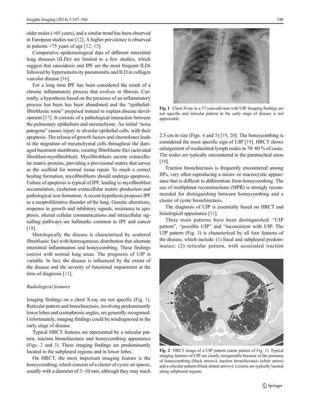 Clinical and radiological features of idiopathic interstitial ... Clinical and radiological features of idiopathic interstitial ...