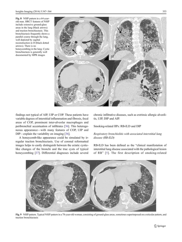 Clinical and radiological features of idiopathic interstitial ... Clinical and radiological features of idiopathic interstitial ...