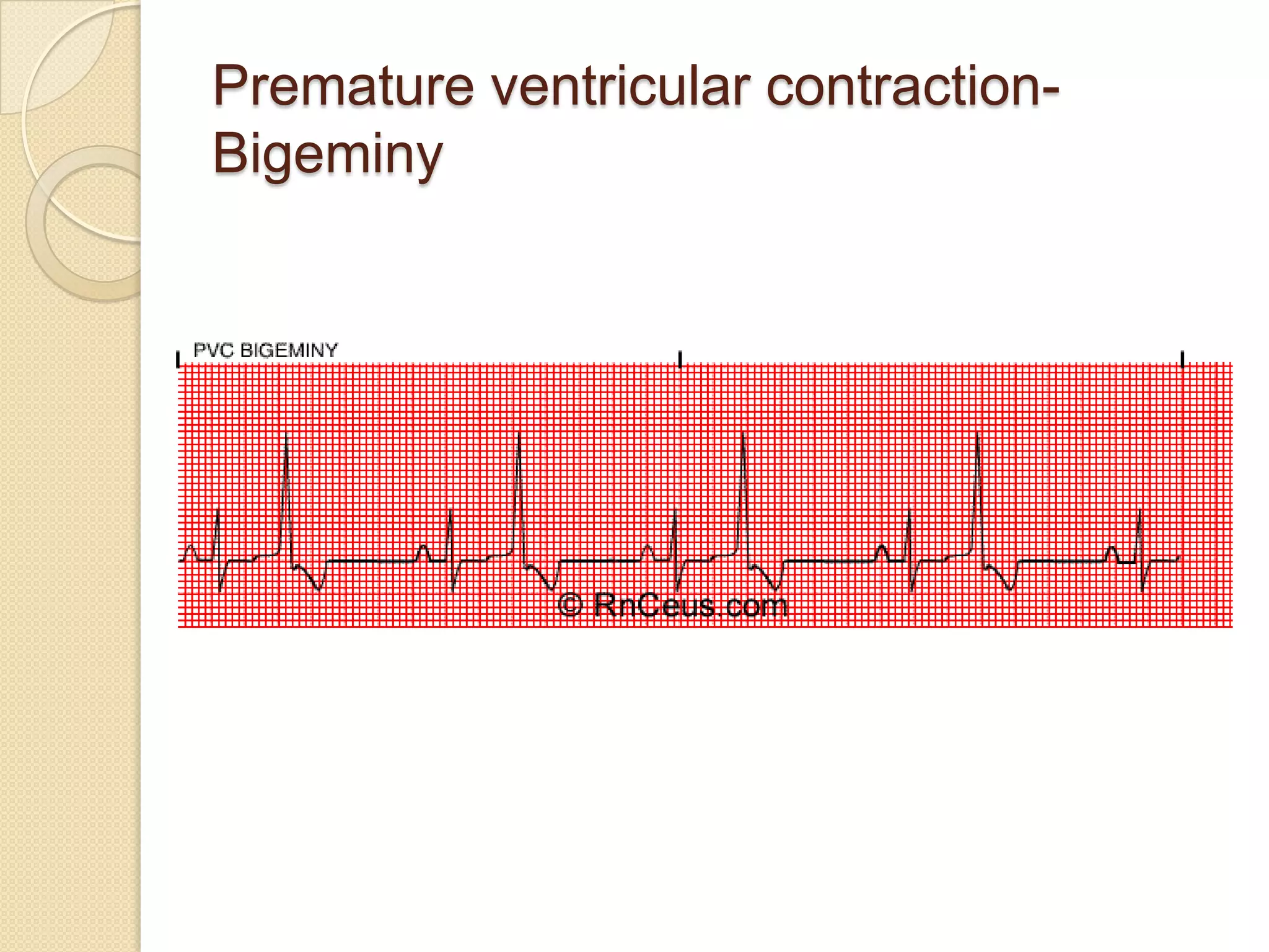 Palpitations | PPTX