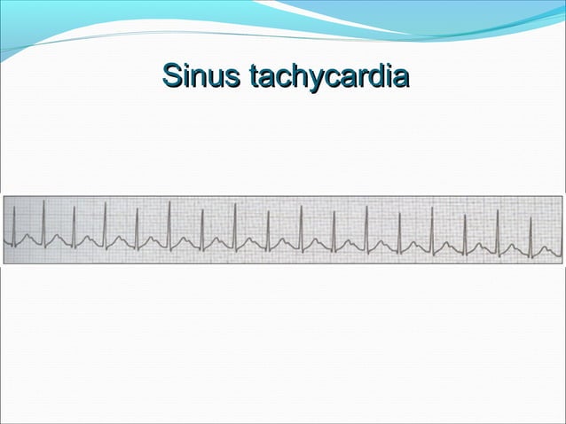 Palpitations | PPT | Heart and Cardiovascular Diseases | Diseases and Conditions