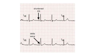 Palpitations.pptx