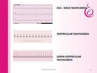 Palpitations in pregnancy by dr alka mukherjee dr apurva mukherjee ...