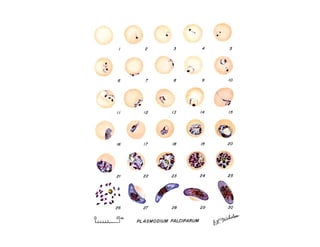 Resumen de Paludismo o Malaria 2024.pdf. | PDF