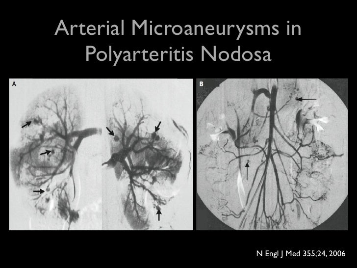 Panarteritis Nodosa