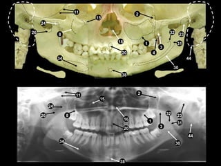 panoramic radiographic landmarks in dentistry | PPT