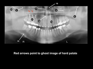 panoramic radiographic landmarks in dentistry | PPT