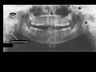 panoramic radiographic landmarks in dentistry | PPT