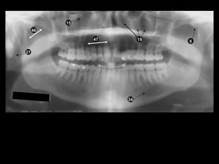 panoramic radiographic landmarks in dentistry | PPT