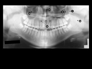 panoramic radiographic landmarks in dentistry | PPT