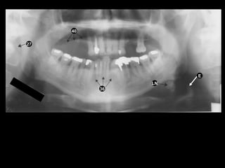 panoramic radiographic landmarks in dentistry | PPT