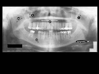 panoramic radiographic landmarks in dentistry | PPT
