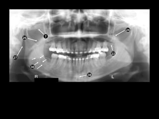 panoramic radiographic landmarks in dentistry | PPT