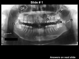 panoramic radiographic landmarks in dentistry | PPT