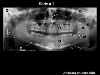 panoramic radiographic landmarks in dentistry | PPT