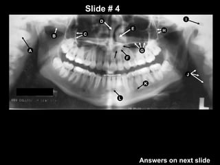 panoramic radiographic landmarks in dentistry | PPT