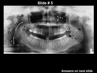 panoramic radiographic landmarks in dentistry | PPT