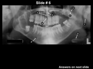panoramic radiographic landmarks in dentistry | PPT