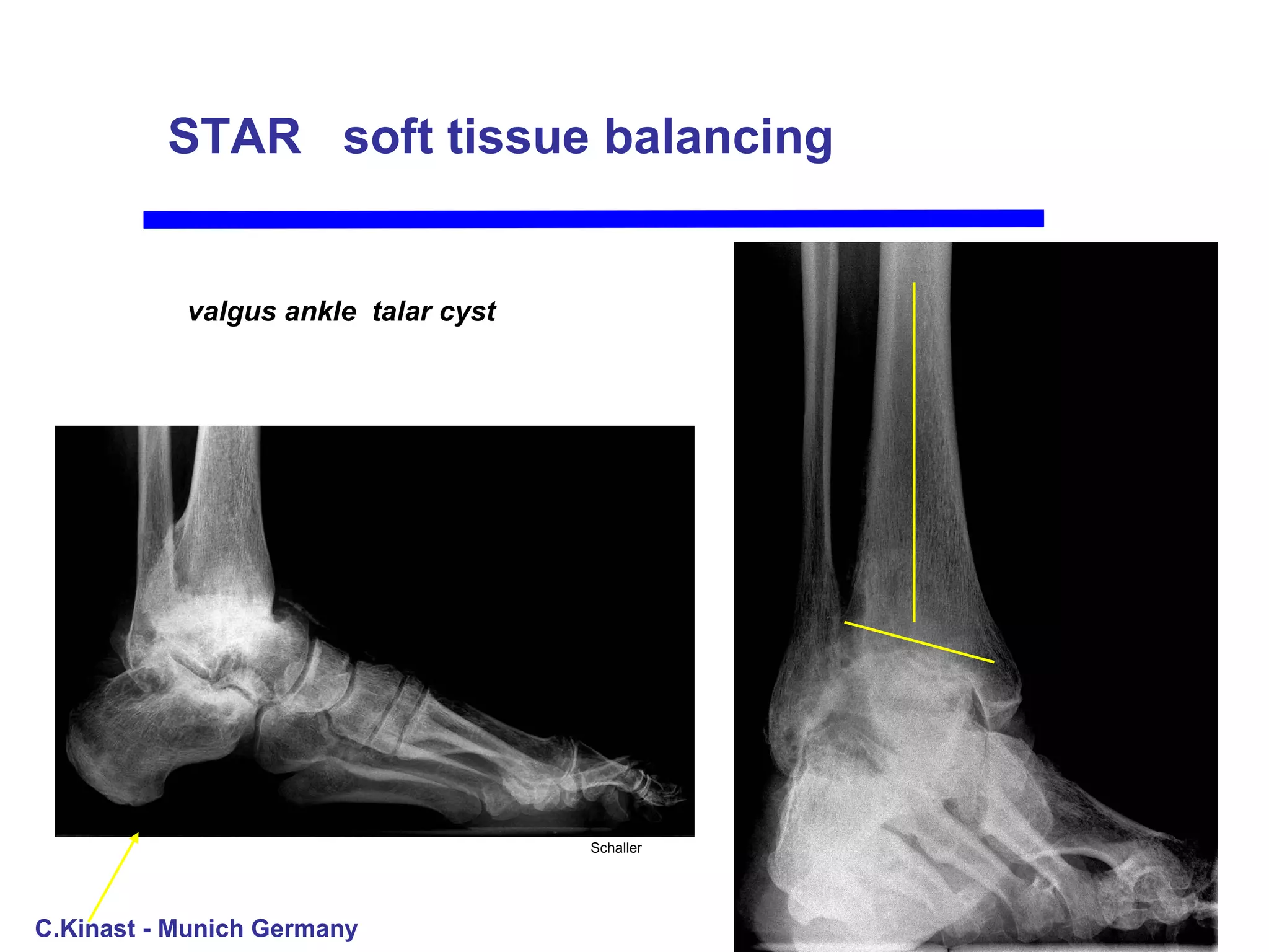 Ten Year Experience with the STAR Total Ankle Replacement | PPT