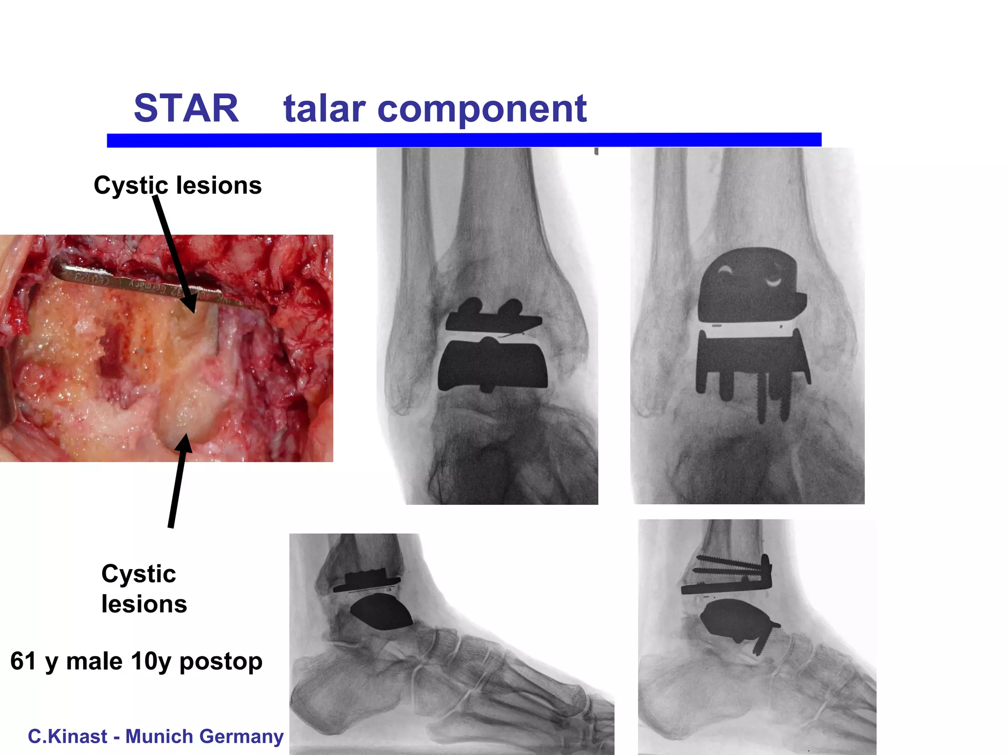 Ten Year Experience with the STAR Total Ankle Replacement | PPT
