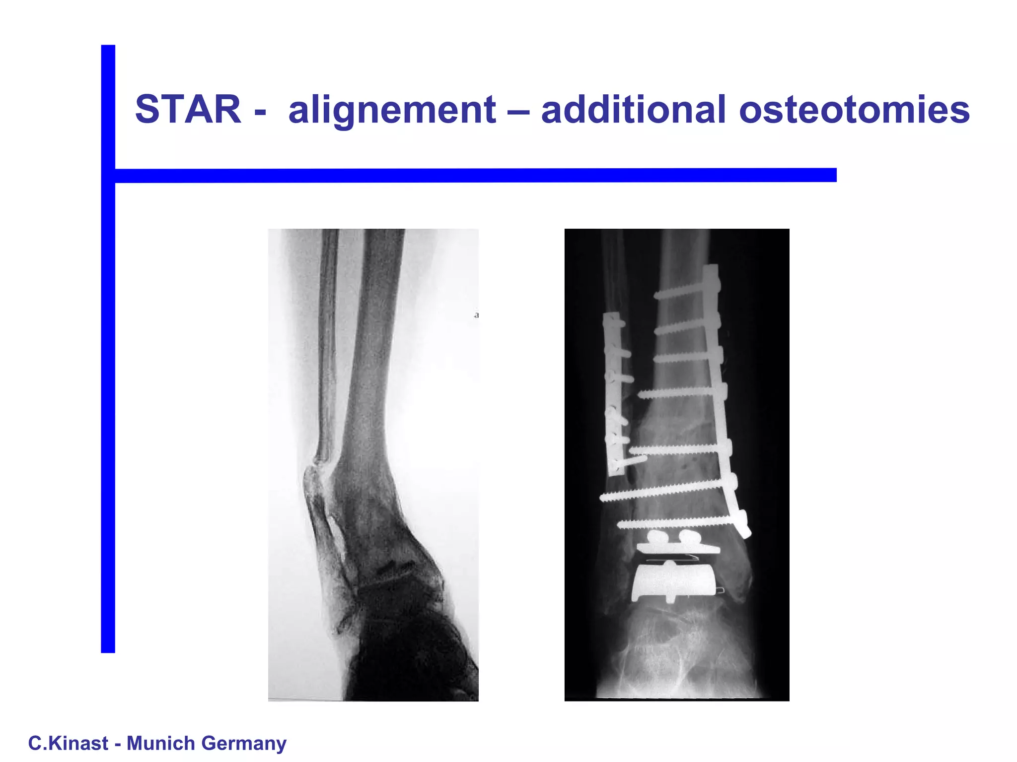 Ten Year Experience with the STAR Total Ankle Replacement | PPT