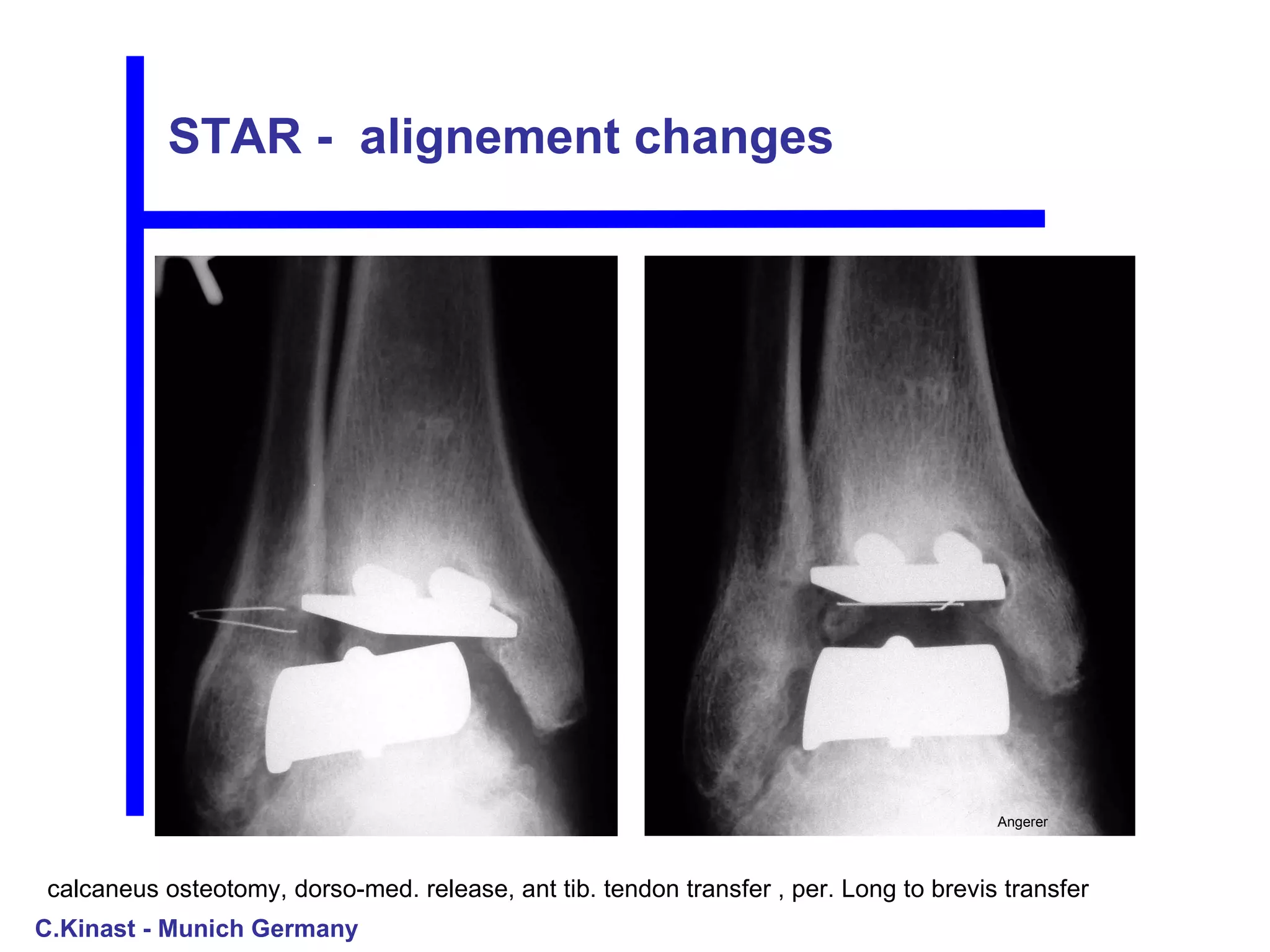 Ten Year Experience with the STAR Total Ankle Replacement | PPT