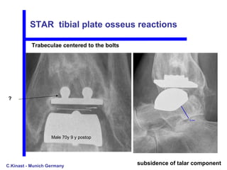 Ten Year Experience with the STAR Total Ankle Replacement | PPT