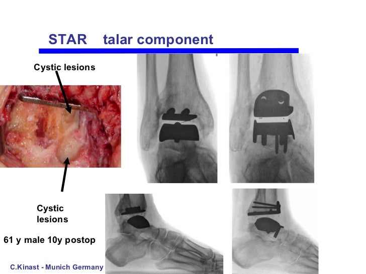 Ten Year Experience with the STAR Total Ankle Replacement