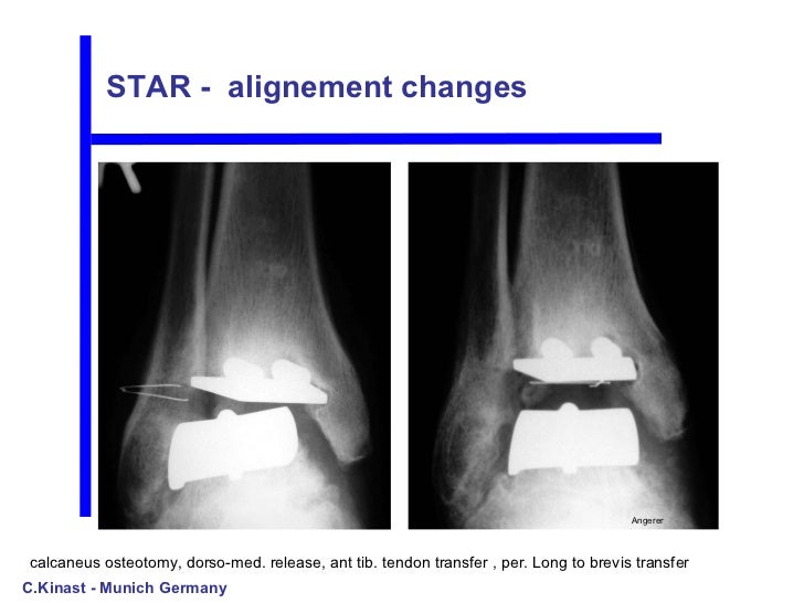 Ten Year Experience with the STAR Total Ankle Replacement