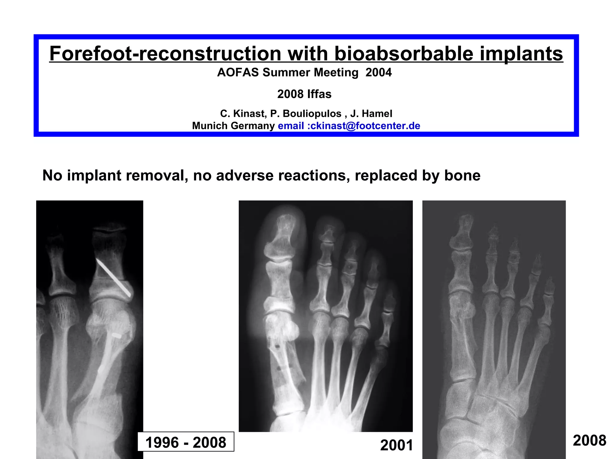 Bioabsorbable Implants for Fixation of Scarf and Akin Osteotomies and ...