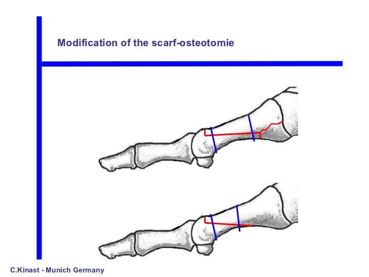 Scarf Akin Procedure