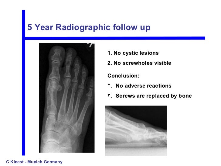 Scarf Akin Procedure