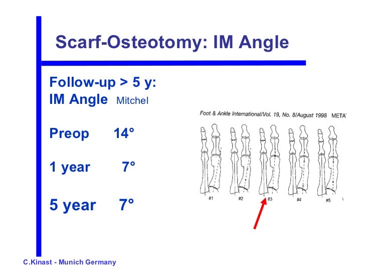 Scarf Akin Procedure