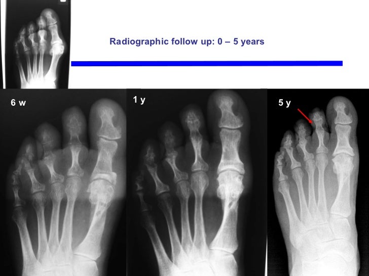 Scarf Akin Procedure
