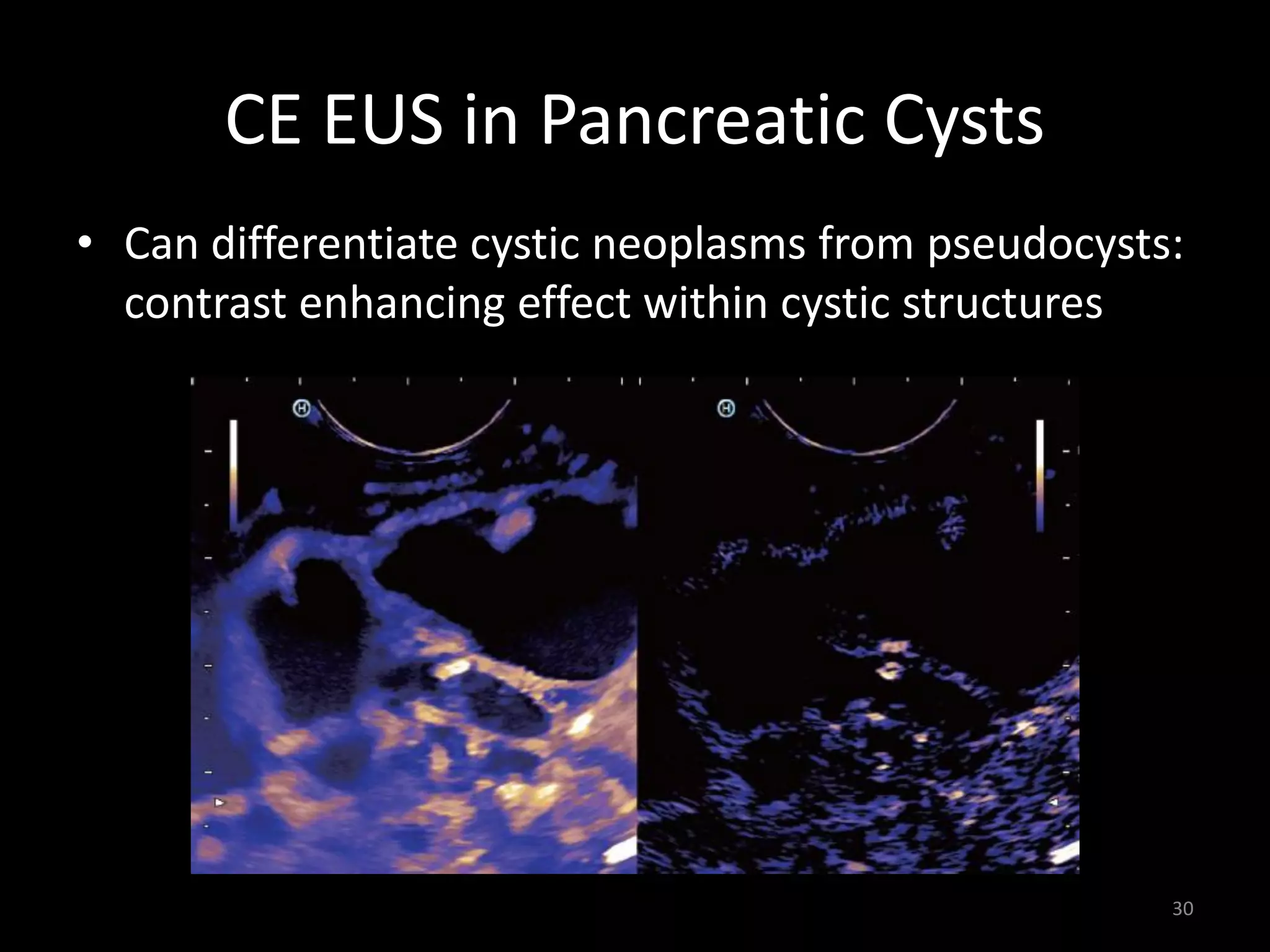 Pancreatic Cysts: A Contemporary Approach | PDF
