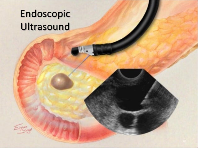 Pancreatic Cysts: A Contemporary Approach
