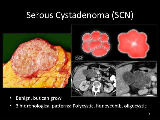 Pancreatic Serous Cystadenoma Ultrasound