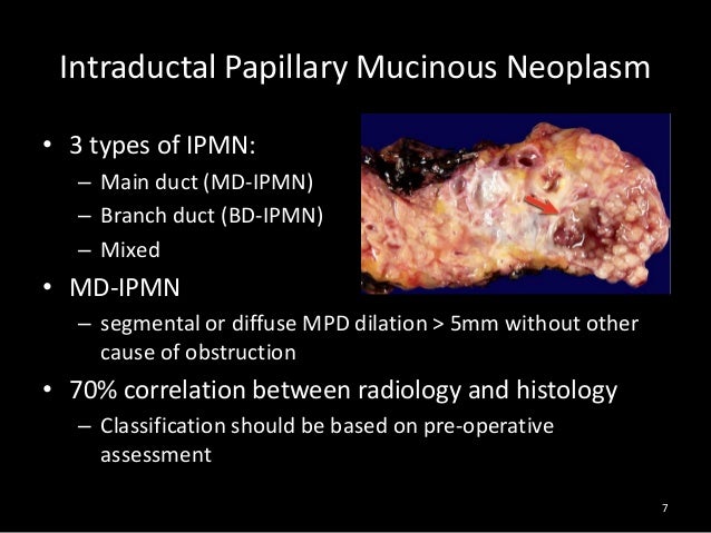 Pancreatic Cysts: A Contemporary Approach